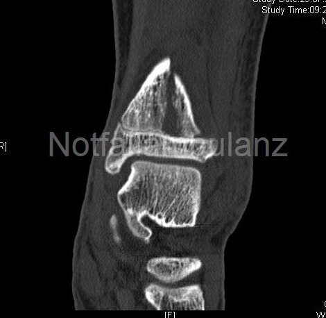Brennpunkt Notaufnahme: Fall 16: Kindliche Distorsion des OSG: Triplane ...