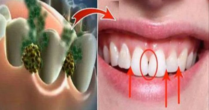 Recetas Naturales: Remedio efectivo para eliminar el mal aliento en 5 ...