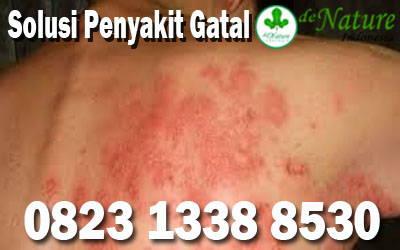 Obat Sembuhkan Gatal Scabies Yang Ampuh Di Apotik | Obat Khusus Gatal