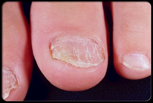 Help with your feet: Psoriasis