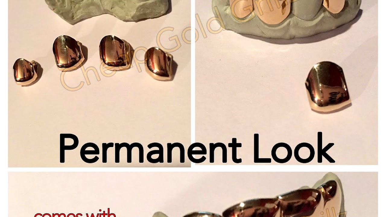 Where To Get Permanent Gold Teeth - Gold Choices
