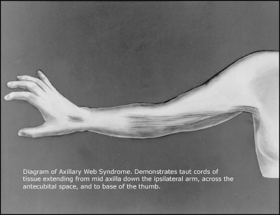 Knock Knock , it's cancer!: Axillary web syndrome