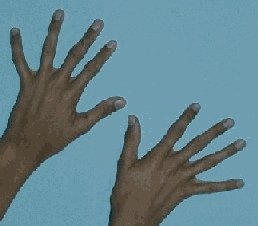 Nuestro esqueleto: Miembro superior: Malformaciones óseas de la mano