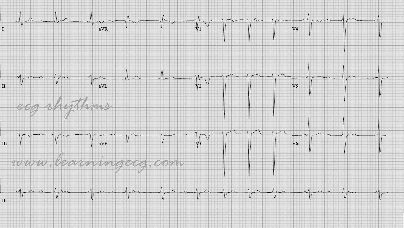 Heart Block Ecg Pdf at Eva Timmins blog Heart Block Ecg Pdf at Eva Timmins blog