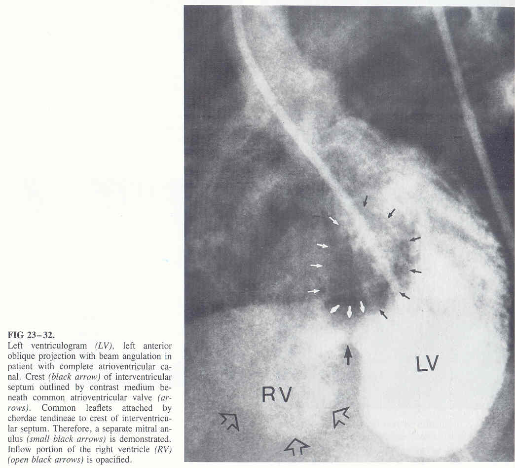 Pedi Cardiology Cath Angiogram Of Avsd Inlet Vsd