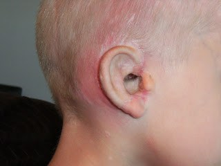 Robbies Little Nubby: Hole in Ear Drum and Another Mosquito Bite 7/11/11