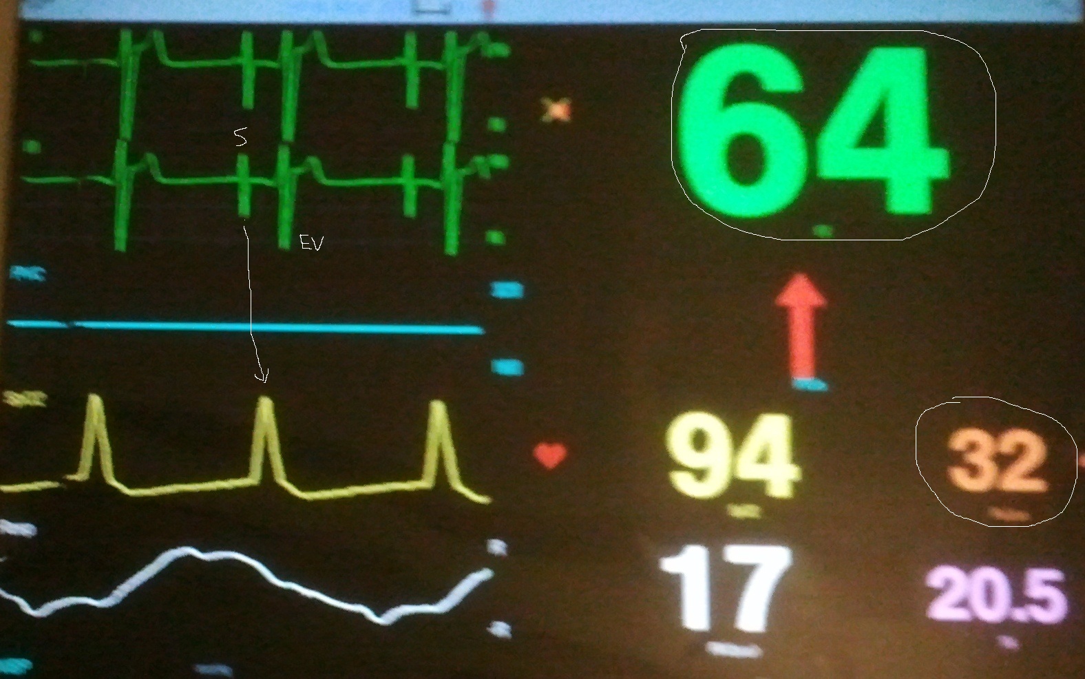 Blog de Eletrocardiografia: BIGEMINISMO VENTRICULAR E ONDA DE PULSO