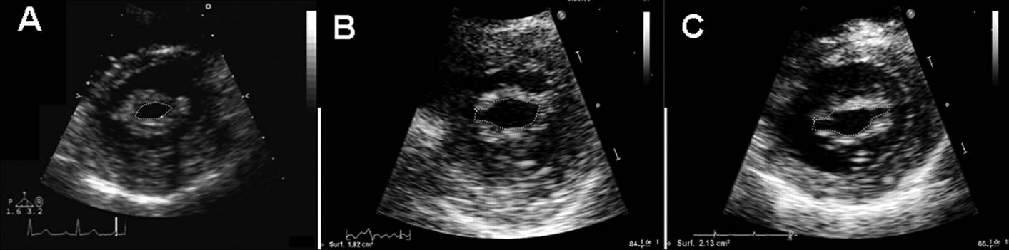 EAE/ASE Guidelines for the Diagnosis of Mitral Stenosis