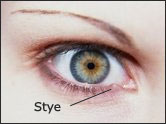 Recipes and Tips To Fight M.S.: Stye in the Eye