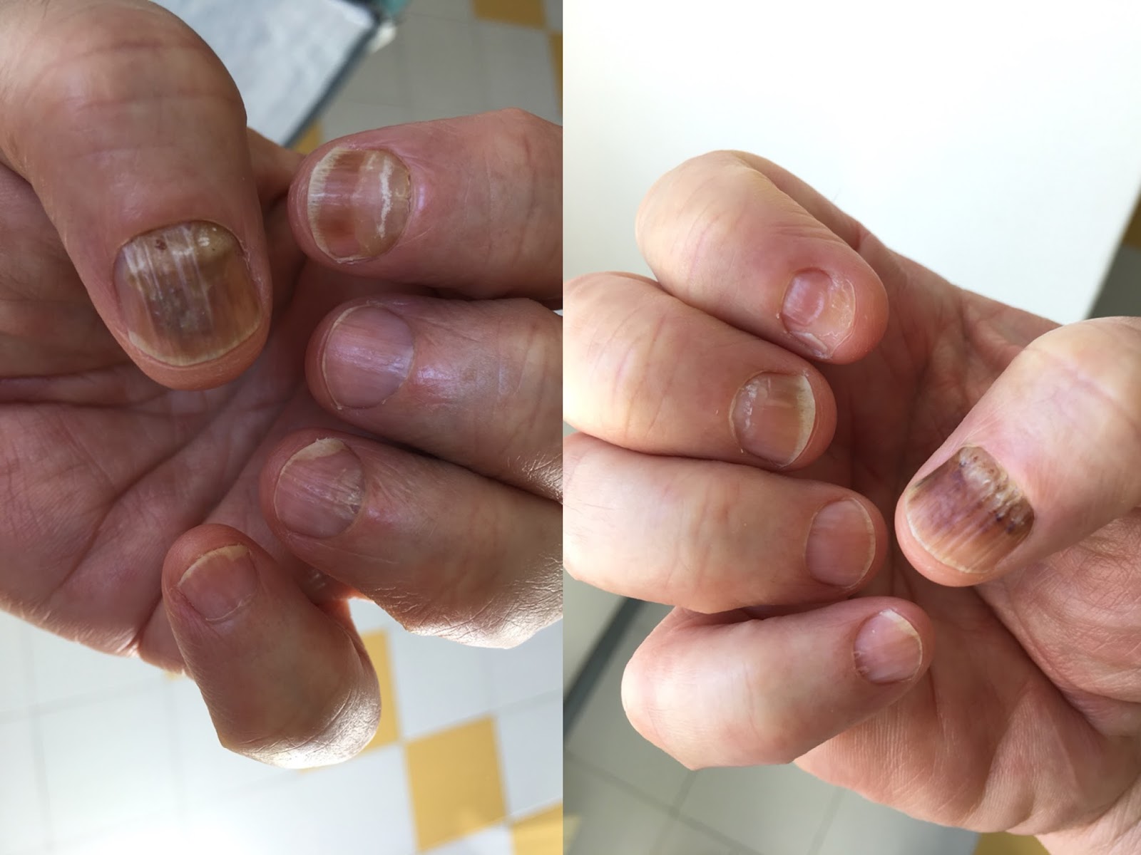 Bocca Mani Piedi: gli adulti manifestano sintomi lievi? Non sempre!: La ...