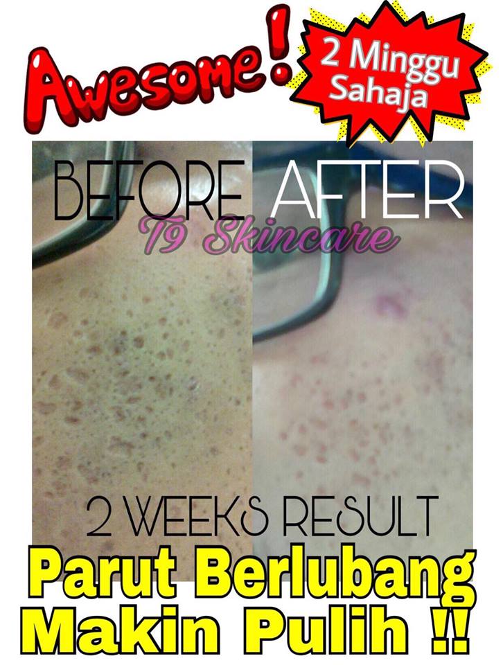 T9 SKINCARE: SERUM HILANG PARUT BERLUBANG & PARUT HITAM DENGAN BERKESAN