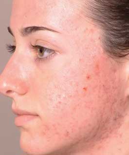 Acne Gone In A Flash Avec ces simples suggestions qui sont indolores et ...