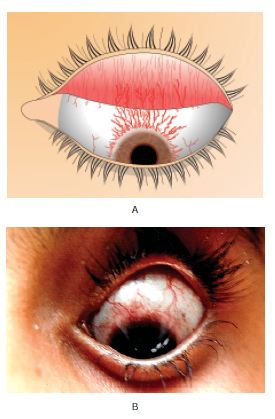 Ophthalmology | Ophthalmologist: SUPERIOR LIMBIC KERATOCONJUNCTIVITIS