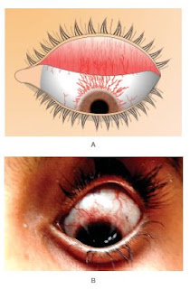 Ophthalmology | Ophthalmologist: SUPERIOR LIMBIC KERATOCONJUNCTIVITIS