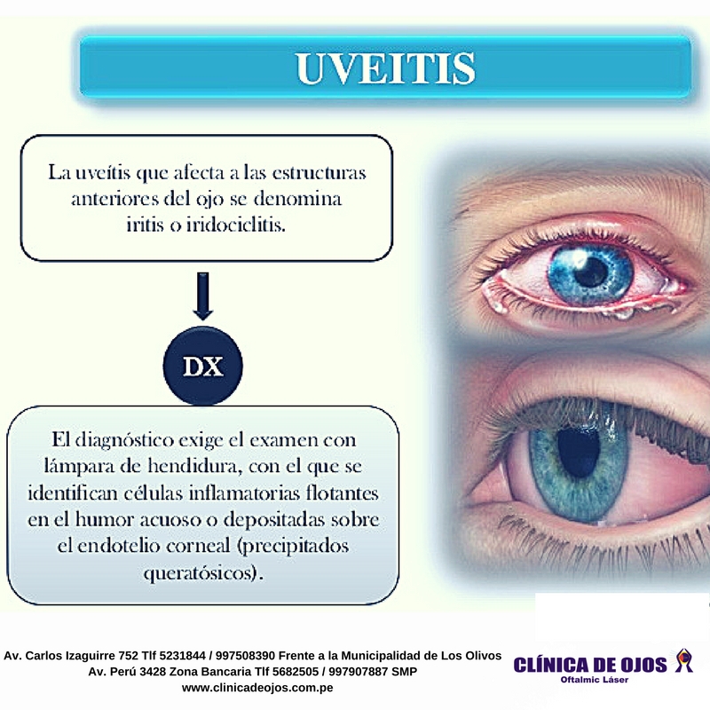 Clínica De Ojos Oftalmic Láser Uveitis