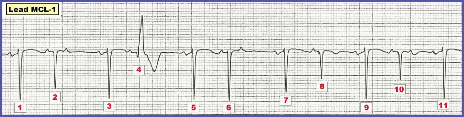ECG Interpretation: ECG Interpretation Review #33 (Bundle Branch Block ...