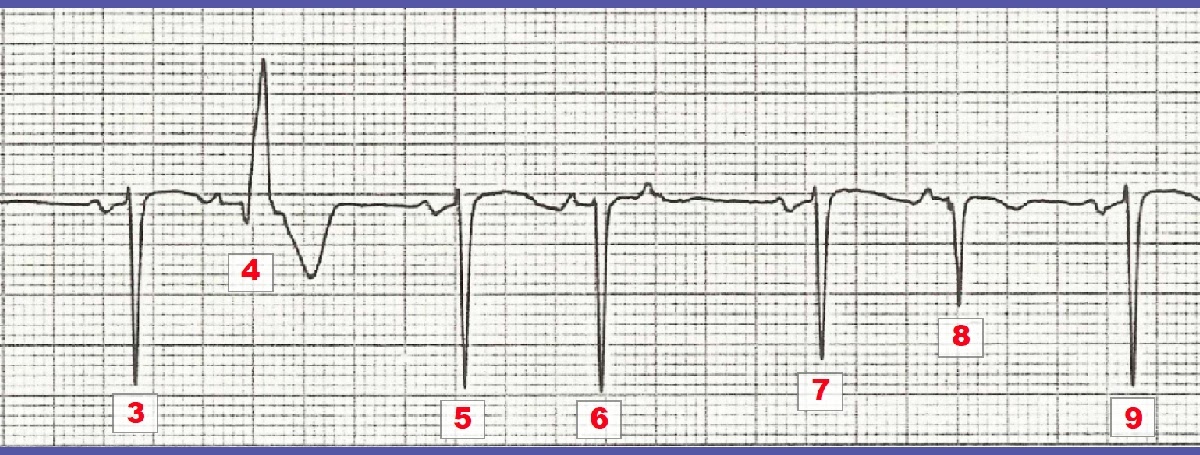 ECG Interpretation: ECG Interpretation Review #33 (Bundle Branch Block ...