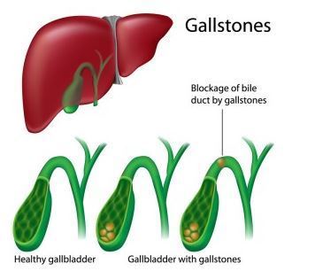 ASUHAN KEPERAWATAN PADA PASIEN CHOLECYSTITIS / KOLESISTITIS | Asuhan ...