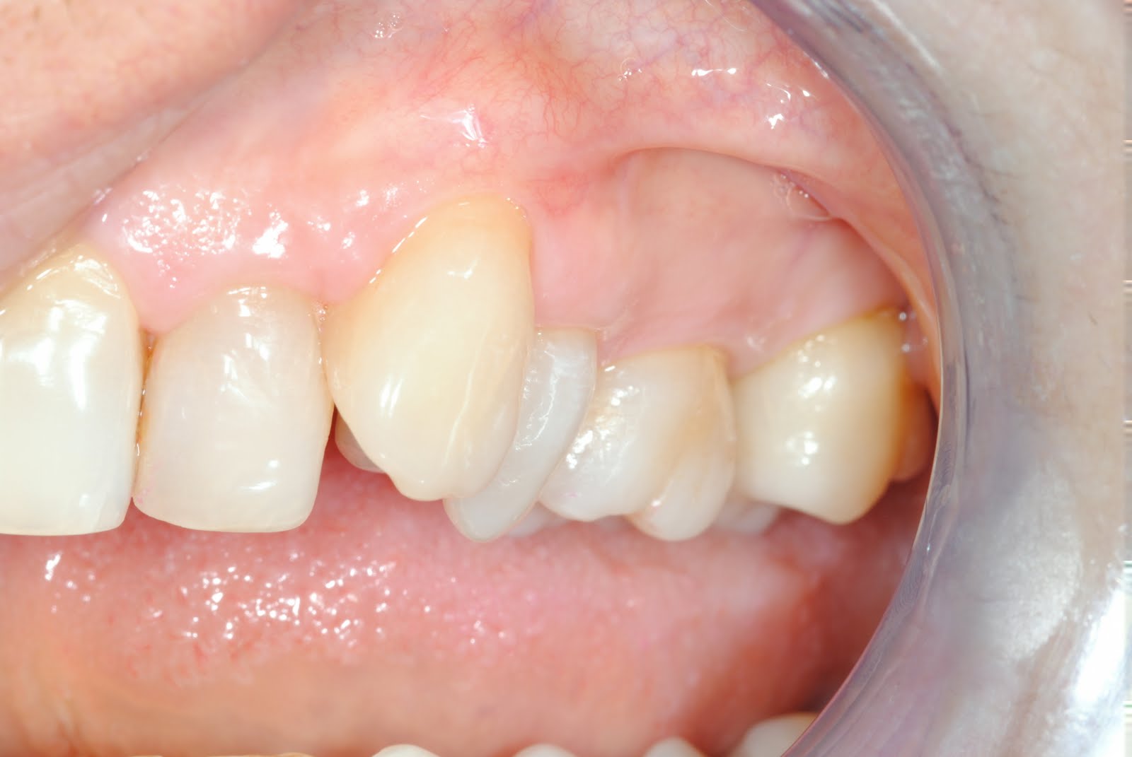 Dr Benoit Paquin: Recouvrement de la gencive