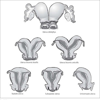 uterus bicornis - Germany News Collections