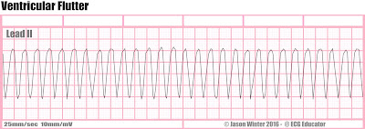 ECG Educator Blog : Ventricular Flutter