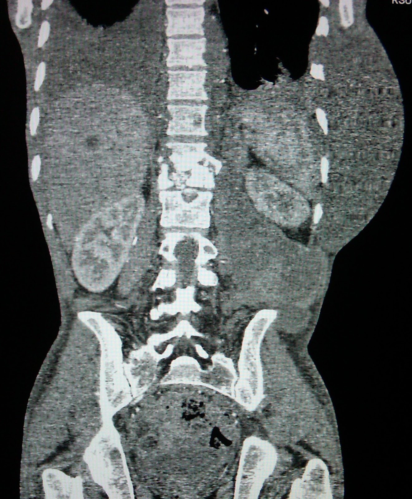 Rachmi Radiologi Solo : Spondylitis TB with Paravetebral soft tissue abses
