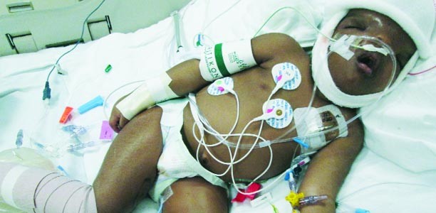Born Without Skull: US Doctors Create Fresh Head For Nigerian Child ...
