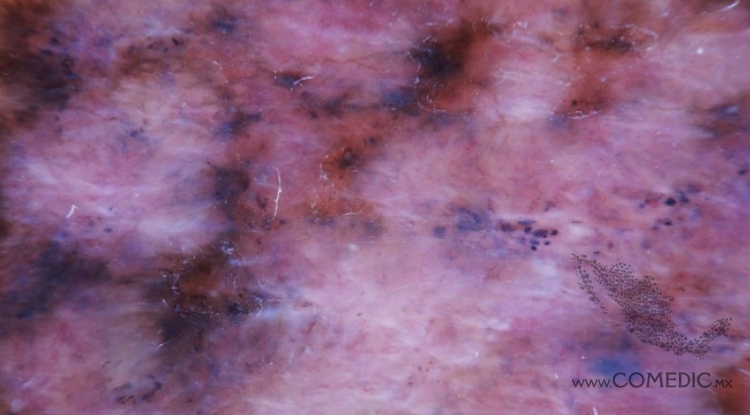 Comedic: Tumor fibroepitelial de pinkus pigmentado