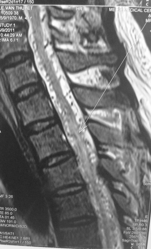 MRI MEDIC CASE STUDIES COLLECTION: SPINAL AVM