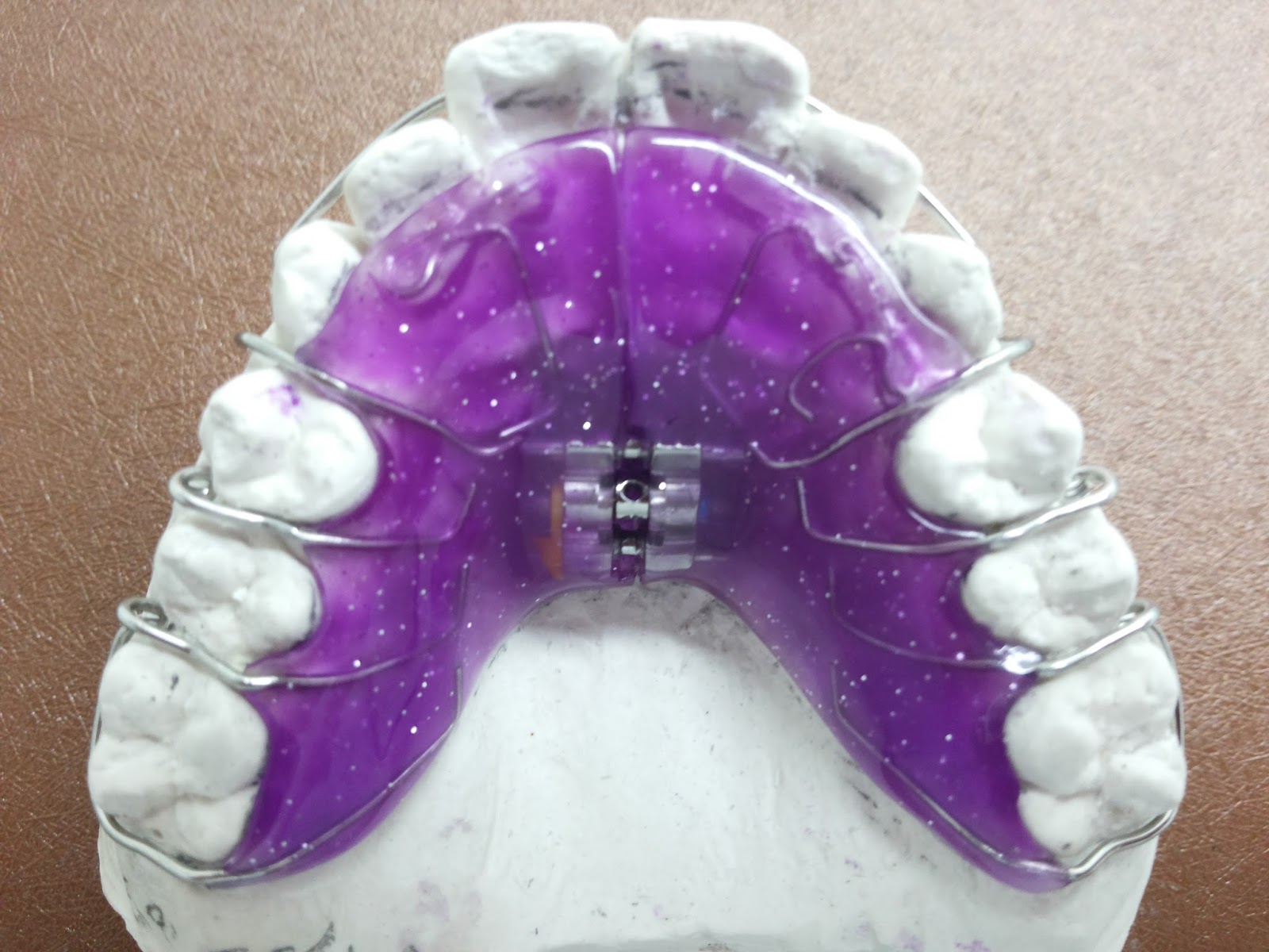 Ortobella: Aparelhos de expansão com arco de hawley.(batente anterior ...