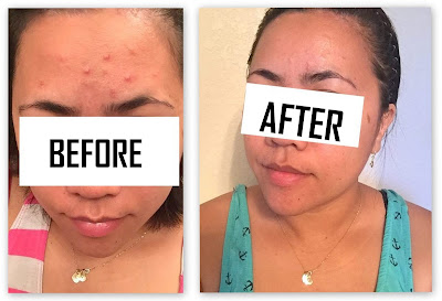 Nu Skin Clear Action Acne Medication System | #NuSkinClear ~ The Dias ...