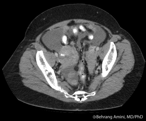 Roentgen Ray Reader: Ovarian Neoplasms with Calcifications