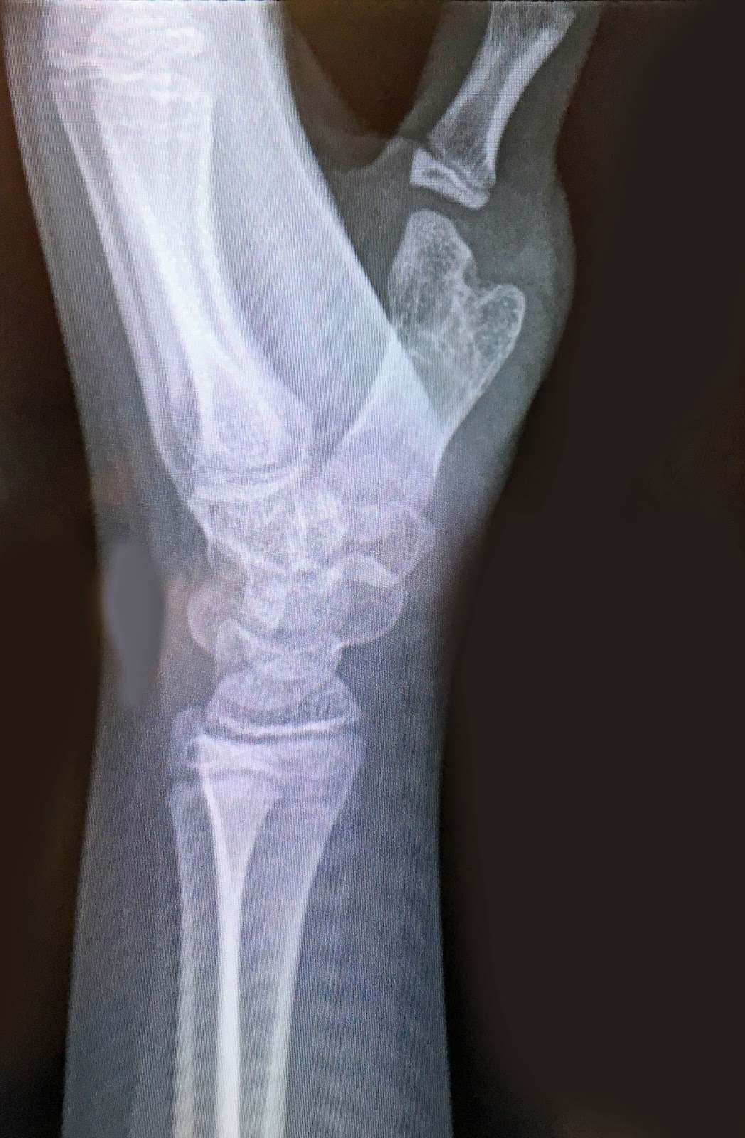 Hand Anomalies and Adoption | Congenital Hand and Arm Differences ...