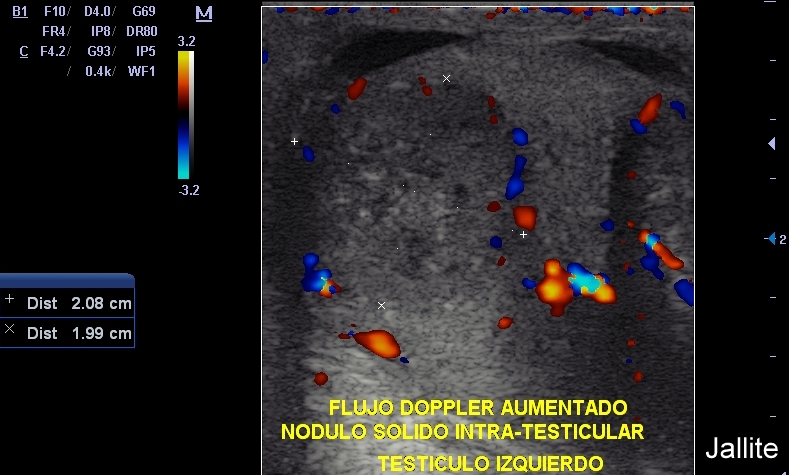 Tuberculosis Testicular