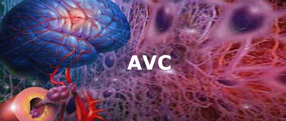 Boca de Mentecapto: ACIDENTE VASCULAR CEREBRAL