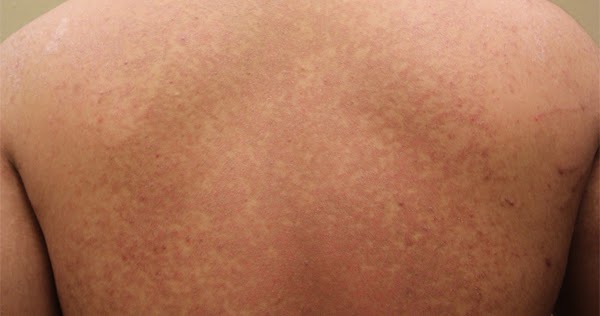 10 Petua Mudah Untuk Hilangkan Panau Dengan Berkesan Tapi Ramai Yang ...