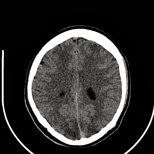 Ultimate Radiology : Bilateral thalamic and cerebellar hypodensity