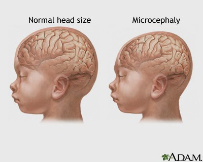 BASIC BIOTECHNOLOGY : MICROCEPHALY