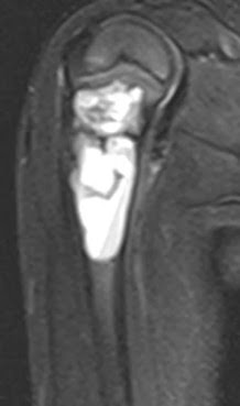 RADIODIAGNOSIS - IMAGE COLLECTION: SIMPLE BONE CYST