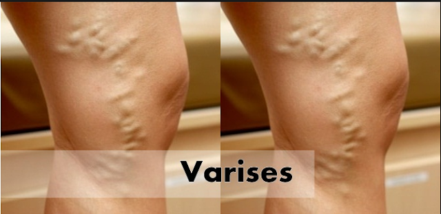 Pengobatan Varises Herbal Secara Alami - Jelly Gamat QnC Asli Original
