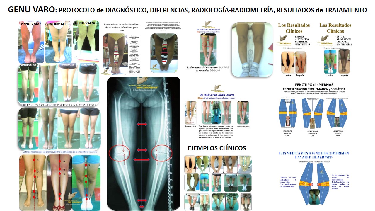 SIN CIRUGÍAS en LÍNEA: GENU VARO-PROTOCOLO de DIAGNÓSTICO y MÁS.