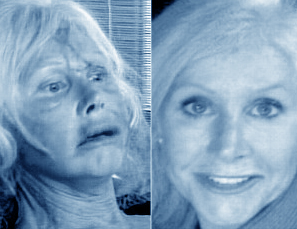 Blue Waffle Disease Pictures: Blue Waffle Disease Pictures