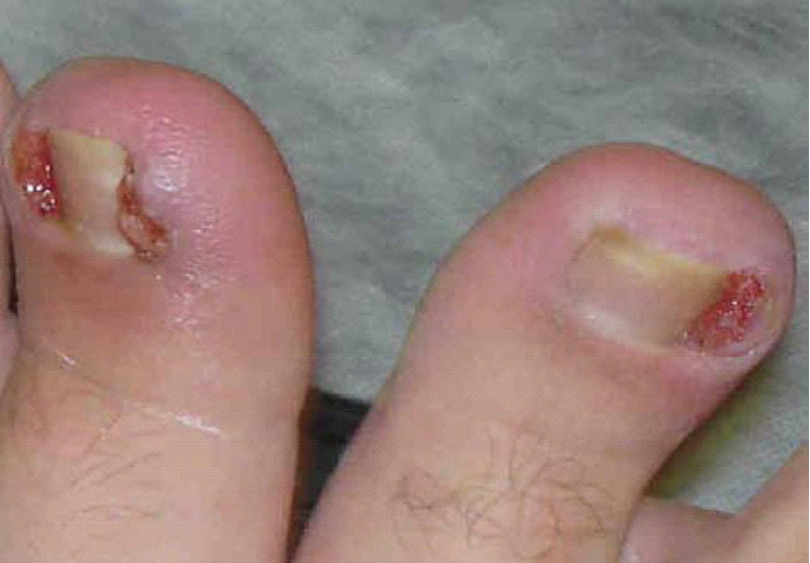 Podologia: Unha encravada (Onicocriptose)