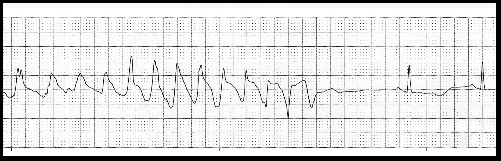 Practice EKG Rhythm Strips 125