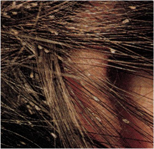 Construyendo una familia: Piojos y liendres