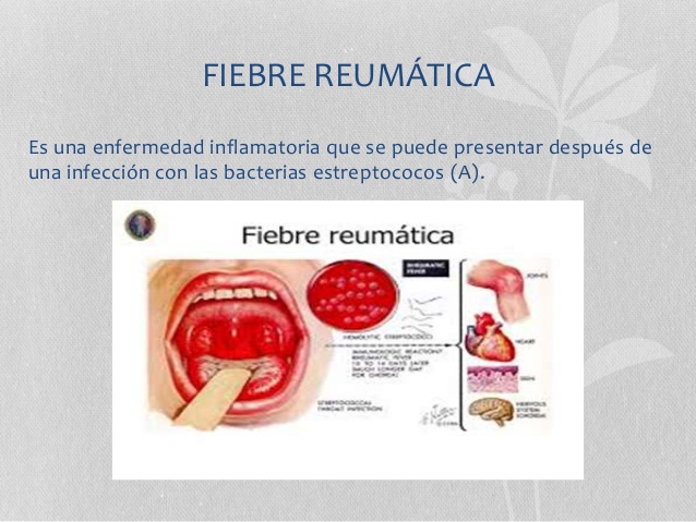AsisMed: Fiebre reumática