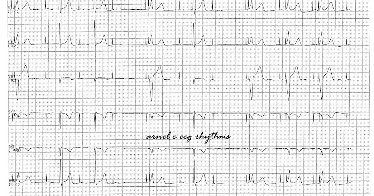 ECG Rhythms: Managed Ventricular Pacing