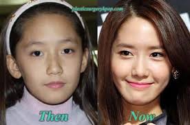 Bukti Nyata Yoona Operasi Plastik Ekstrim