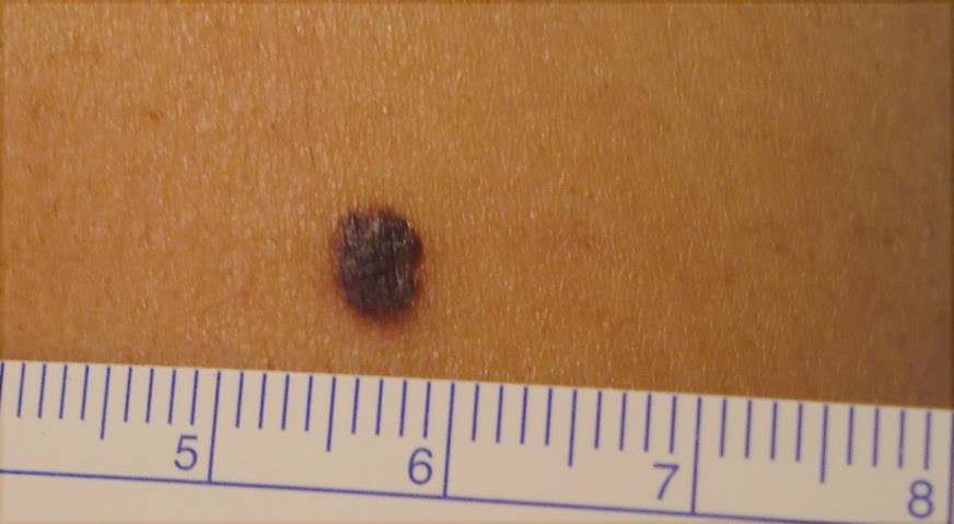 VIRTUAL GRAND ROUNDS IN DERMATOLOGY 2.0: Changing Nevus