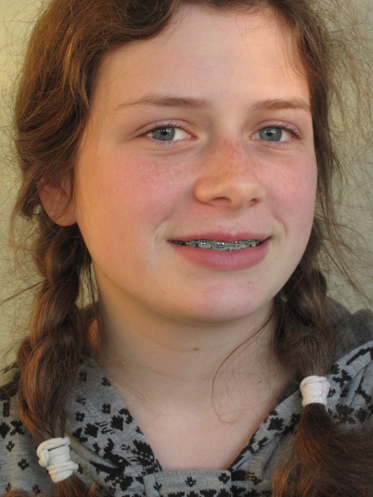 A Woman of Notes: Braces and Badminton